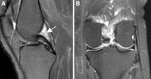 Pericruciate fat pad of the knee: anatomy and pericruciate fat pad ...