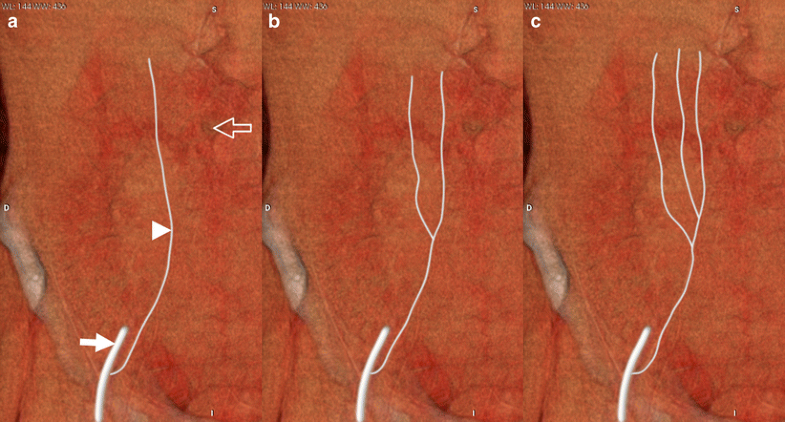 Preoperative imaging in the planning of deep inferior epigastric artery ...
