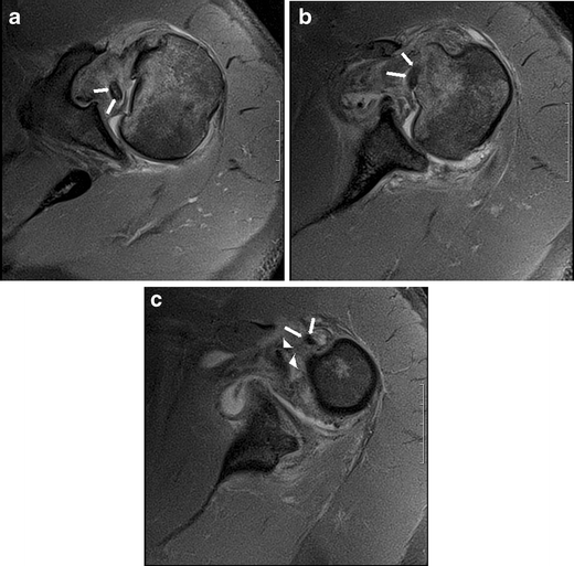 Pseudoparalysis of shoulder caused by glenohumeral interposition of ...