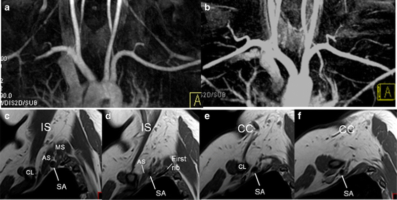 MRI findings in thoracic outlet syndrome | SpringerLink