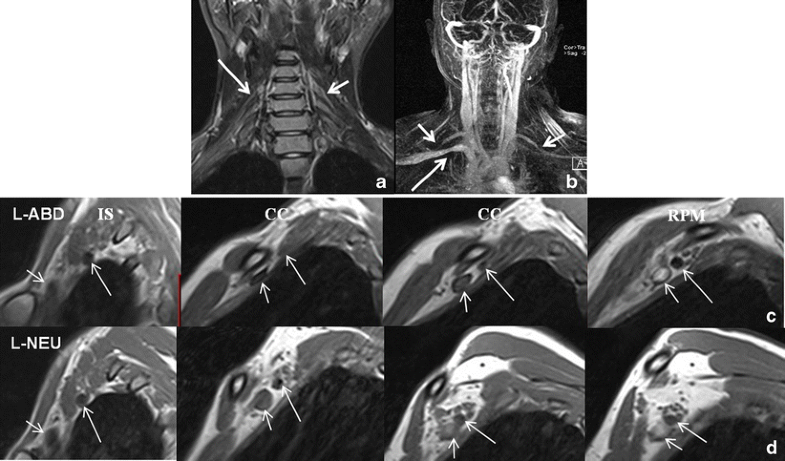 MRI findings in thoracic outlet syndrome | SpringerLink