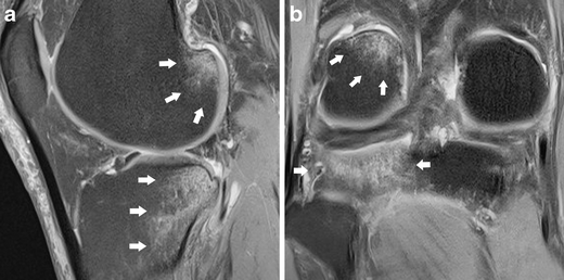 Subchondral impaction fractures of the non-weight-bearing portion of ...