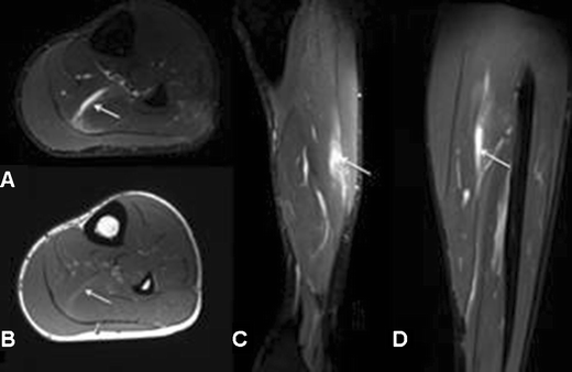 The soleus muscle: MRI, anatomic and histologic findings in cadavers ...