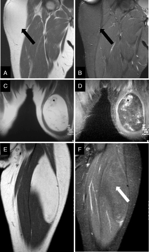 MRI characteristics of lipoma and atypical lipomatous tumor/well ...