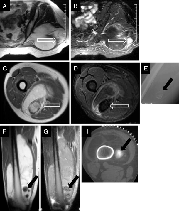 MRI characteristics of lipoma and atypical lipomatous tumor/well ...