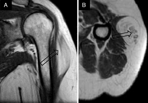 MRI characteristics of lipoma and atypical lipomatous tumor/well ...