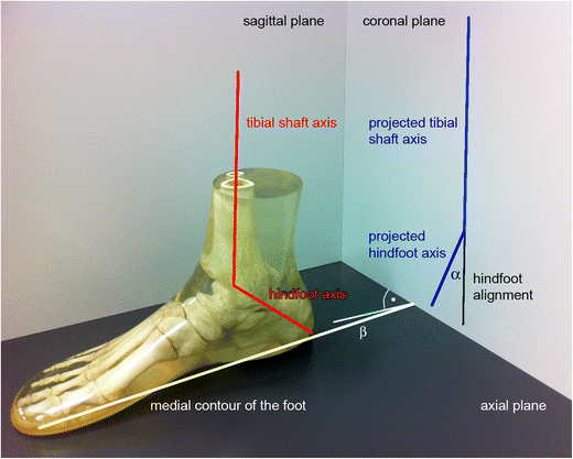 Three-dimensional hindfoot alignment measurements based on biplanar ...