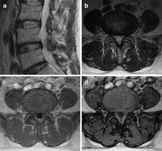 Fatty degeneration of multifidus muscle in patients with chronic low ...