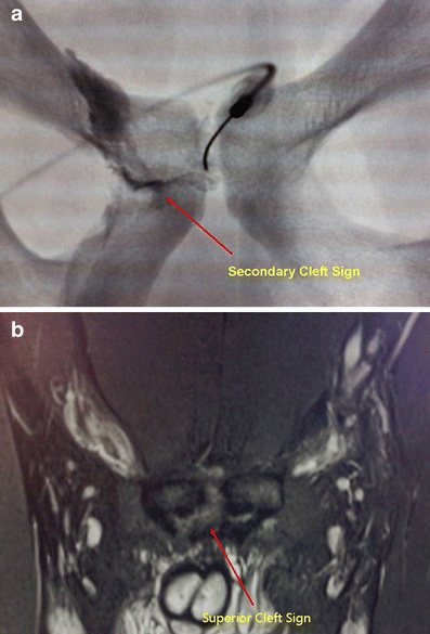 “Superior cleft sign” as a marker of rectus abdominus/adductor longus ...
