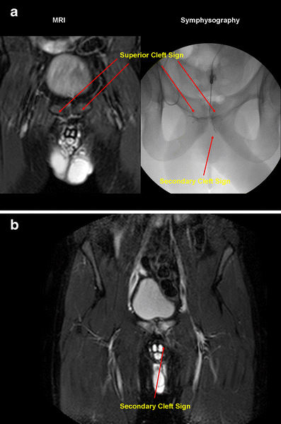 “Superior cleft sign” as a marker of rectus abdominus/adductor longus ...