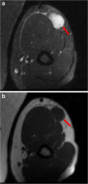 MRI characteristics of nodular fasciitis of the musculoskeletal system ...