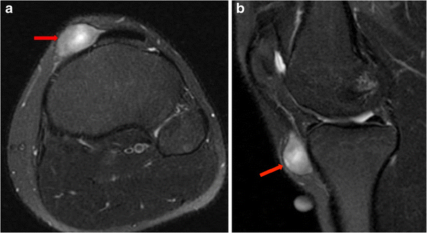 MRI characteristics of nodular fasciitis of the musculoskeletal system ...