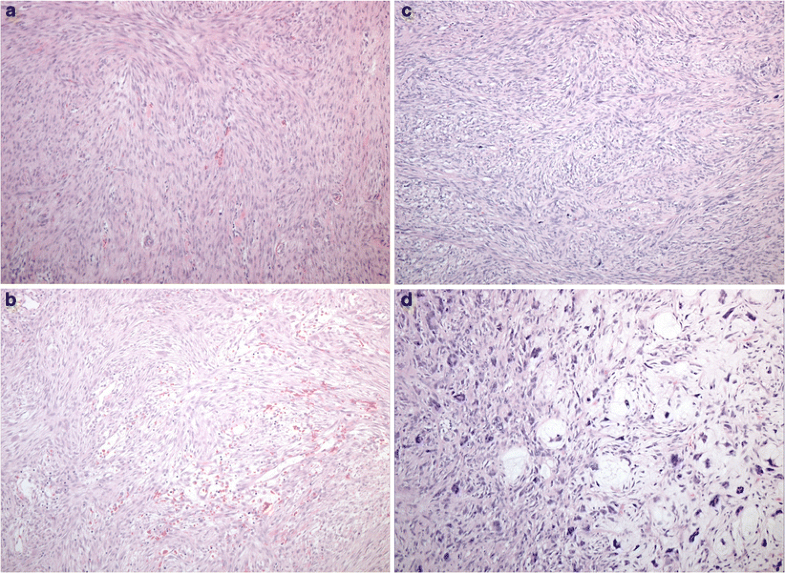 MRI characteristics of nodular fasciitis of the musculoskeletal system ...
