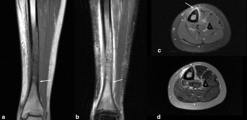 Ewing sarcoma versus osteomyelitis: differential diagnosis with ...