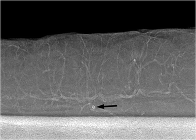 A case report: radiological findings in an unusual case of ...