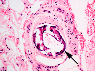 A case report: radiological findings in an unusual case of ...