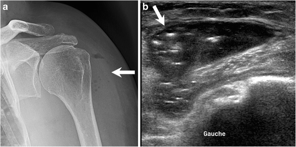 The deltoid, a forgotten muscle of the shoulder | SpringerLink