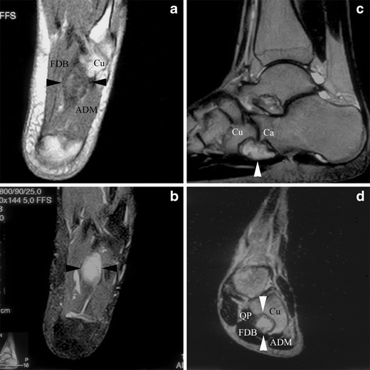 Os cuboideum secundarium: A rare accessory ossicle with the potential ...