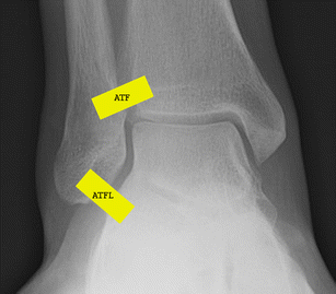 An alternative injection technique for performing MR ankle arthrography ...