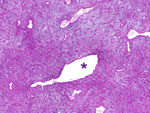Soft tissue angiofibroma: a case report | SpringerLink