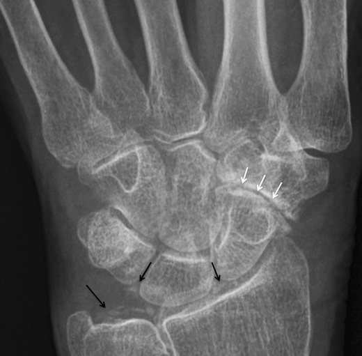 Imaging of radial wrist pain. Part II: pathology | SpringerLink