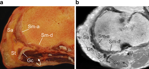 Distal insertions of the semimembranosus tendon: MR imaging with ...