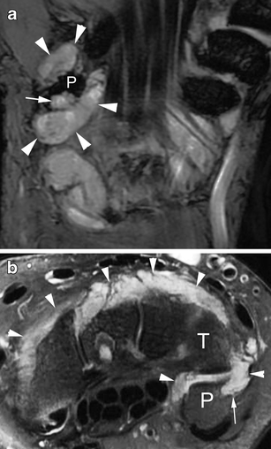 Pisotriquetral joint disorders: an under-recognized cause of ulnar side ...