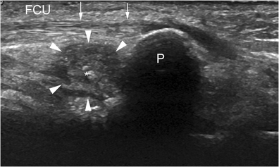 Pisotriquetral joint disorders: an under-recognized cause of ulnar side ...
