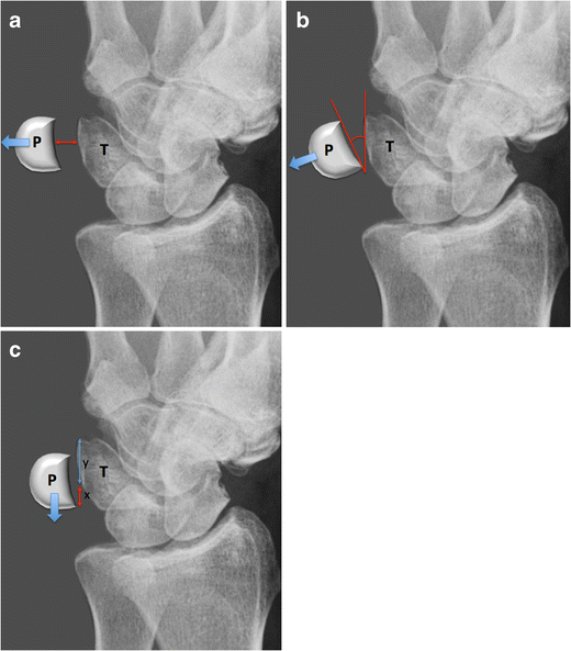 Pisotriquetral joint disorders: an under-recognized cause of ulnar side ...