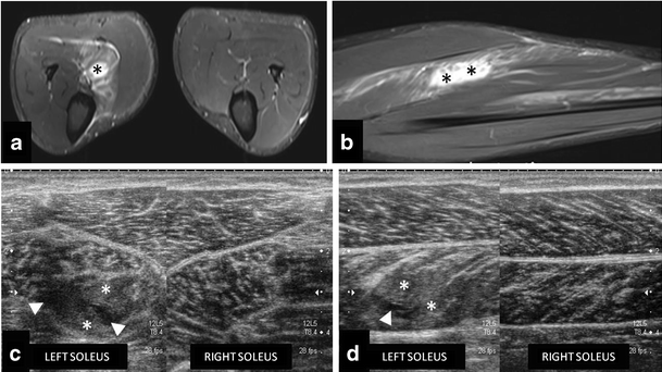 Soleus muscle injury: sensitivity of ultrasound patterns | SpringerLink