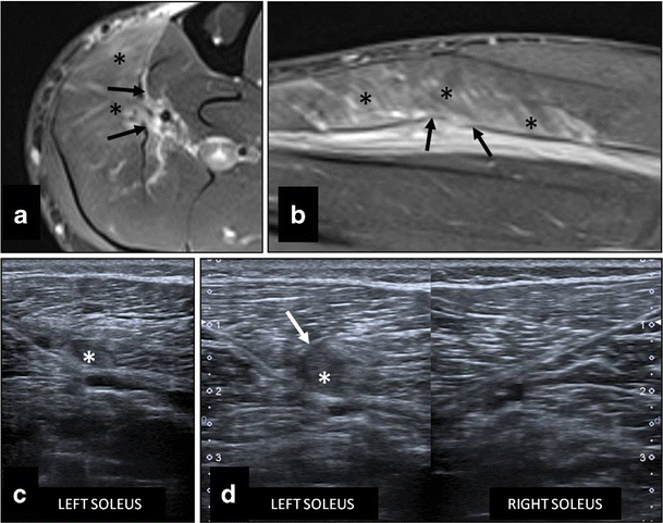 Soleus muscle injury: sensitivity of ultrasound patterns | SpringerLink