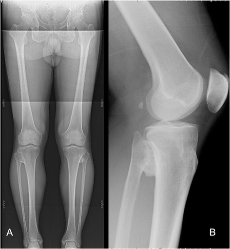 Bilateral non-osteochondroma-related proximal tibiofibular synostosis ...