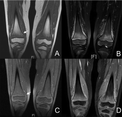 MRI findings in pediatric patients with scurvy | SpringerLink