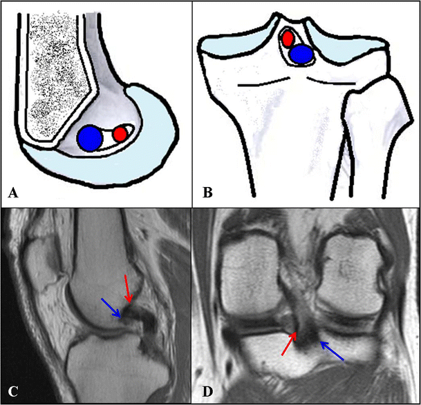 Imaging of posterior cruciate ligament (PCL) reconstruction: normal ...