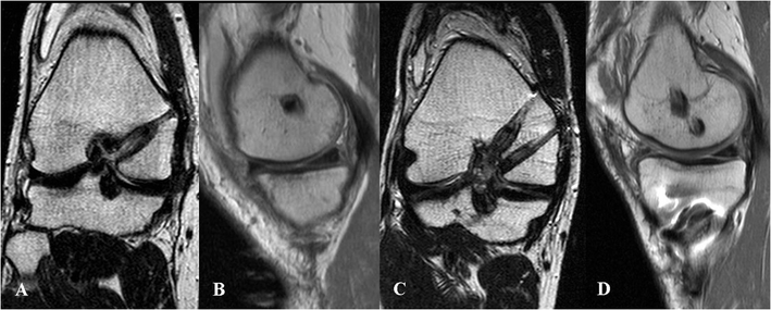 Imaging of posterior cruciate ligament (PCL) reconstruction: normal ...