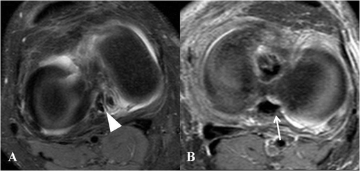 Imaging of posterior cruciate ligament (PCL) reconstruction: normal ...