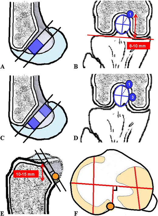 Imaging of posterior cruciate ligament (PCL) reconstruction: normal ...