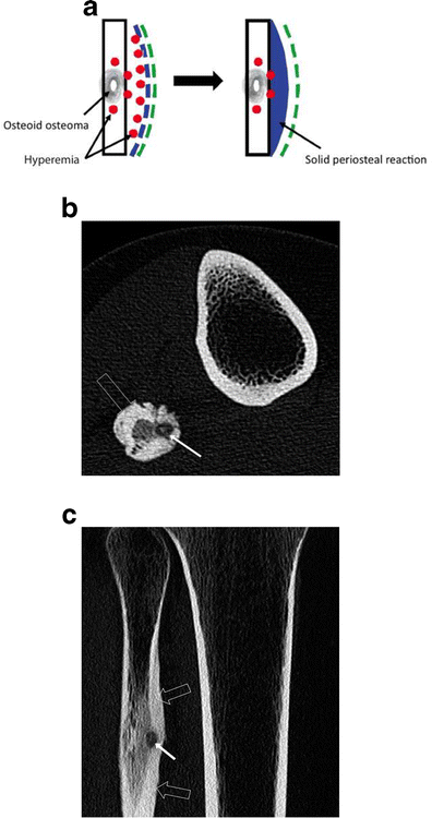 Periosteum: Characteristic imaging findings with emphasis on radiologic ...