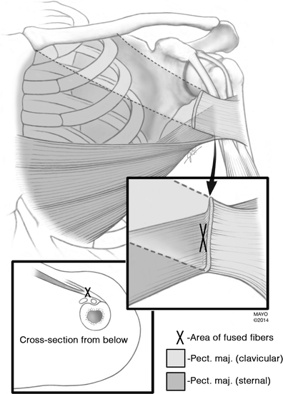 Pectoralis major tears: anatomy, classification, and diagnosis with ...