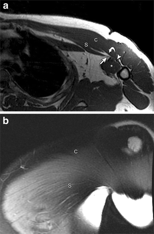 Pectoralis major tears: anatomy, classification, and diagnosis with ...