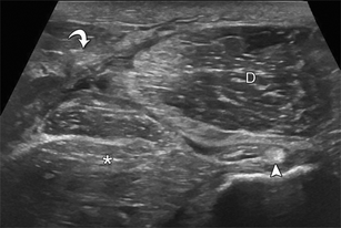 Pectoralis major tears: anatomy, classification, and diagnosis with ...
