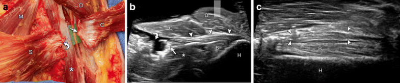 Pectoralis major tears: anatomy, classification, and diagnosis with ...