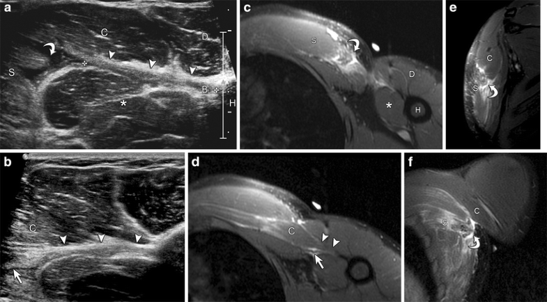 Pectoralis major tears: anatomy, classification, and diagnosis with ...