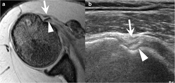 The aponeurotic expansion of the supraspinatus tendon: anatomy and ...