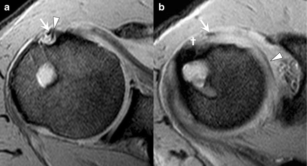 The aponeurotic expansion of the supraspinatus tendon: anatomy and ...