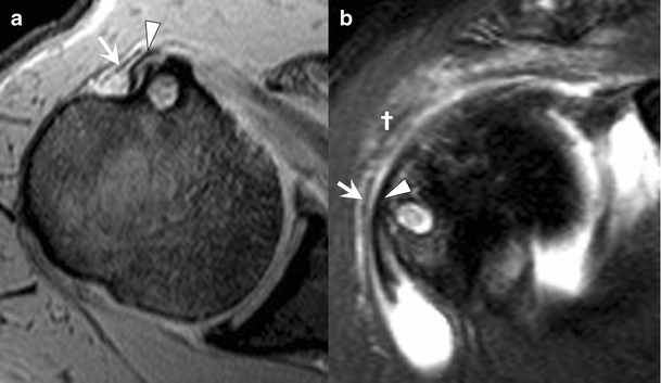 The aponeurotic expansion of the supraspinatus tendon: anatomy and ...