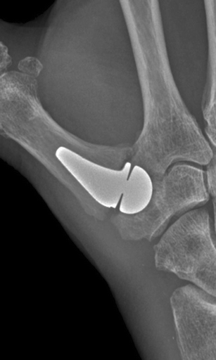 Imaging and management of thumb carpometacarpal joint osteoarthritis ...