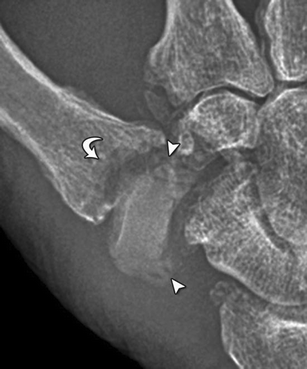 Imaging and management of thumb carpometacarpal joint osteoarthritis ...
