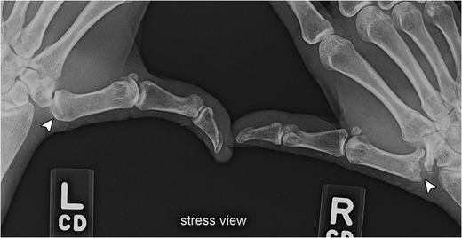 Imaging and management of thumb carpometacarpal joint osteoarthritis ...