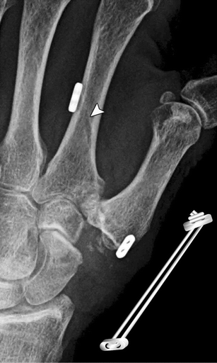 Imaging and management of thumb carpometacarpal joint osteoarthritis ...